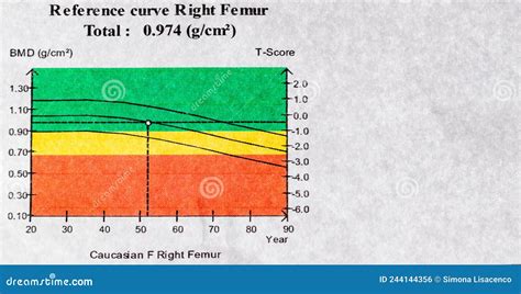 Hip Bone Mineral Density Bmd Dexa Densitometry Hip Scan Osteopenia Is