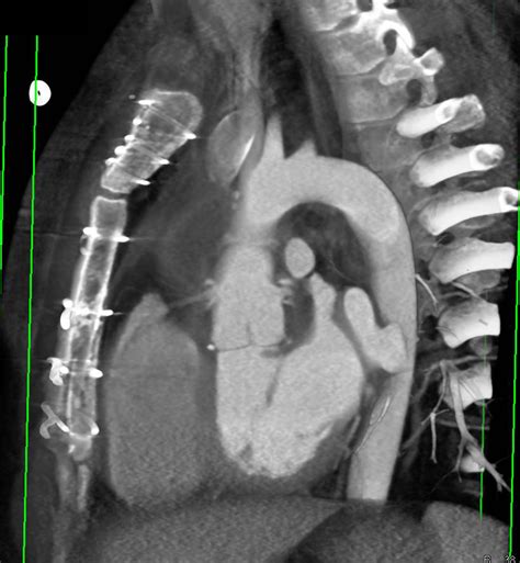 Aortic Root And Ascending Aorta Repair Note The Thrombus On Aortic