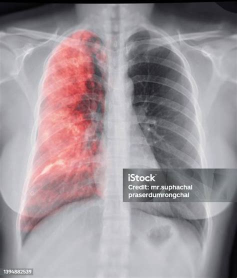 Rontgen Dada Dengan Gambar Rendering 3d Paruparu Untuk Diagnosis Tb Tbc