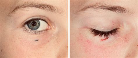 Pediatric Office Procedures With Pro Nox™ Nitrous Oxide Skin Cancer