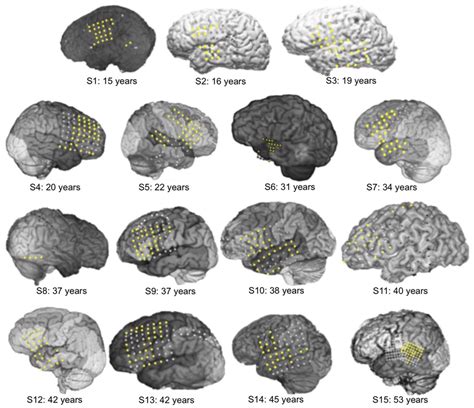 Electrode Locations For Research Participants Intracranial