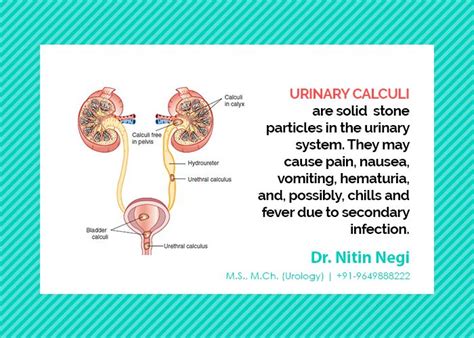 Urinary Calculi Dr Nitin Negi Mch Ms Urology Wireless 91 9649888222