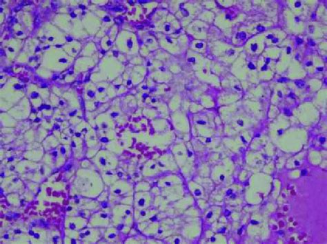 Histological Examination Of The Right Renal Lesion Showed Clear Cell