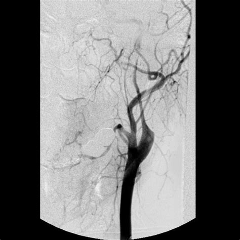 Internal Carotid Artery Dissection Pacs