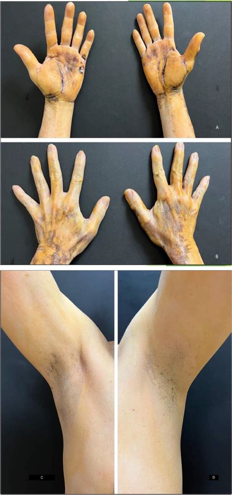 Sudden Onset Anhidrosis In An Otherwise Healthy Male Tan 2023