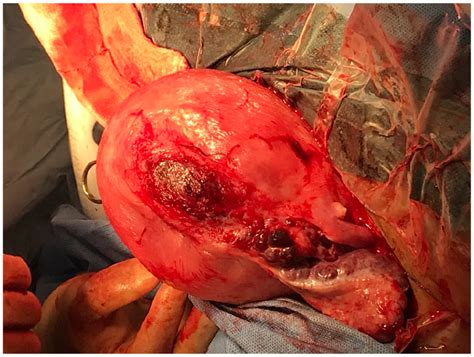 A Cornual Placenta Percreta At The Site Of Excision Of Previous Cornual Download Scientific