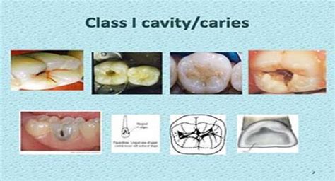 Download Free Medical Classification Of Cavities Powerpoint Presentation