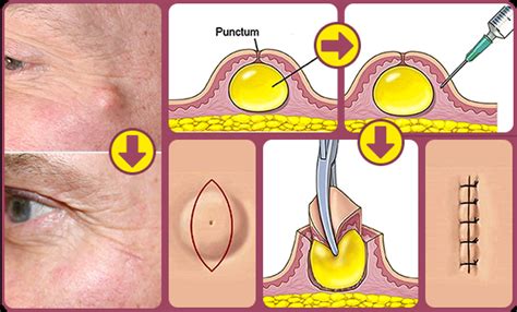Sebaceous Cyst Removal Dr Sajjas Clinic In Tirupati