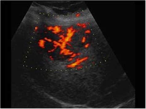 Abdomen And Retroperitoneum 11 Liver Case 111 Focal Nodular
