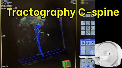 Dti C Spine Youtube