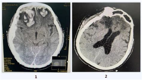 76岁老人颅脑手术术后意识不清，中西医结合治疗成功促醒 健康用药 番禺区中医院