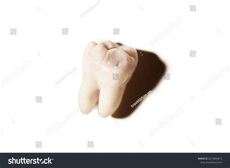 162 Third Molar Surgery Images Stock Photos Vectors Shutterstock