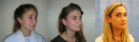 Rhinoplasty Nose Job Surgery In Manchester And London Waseem Saeed