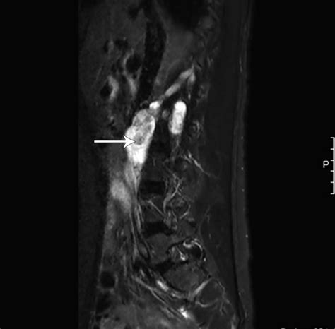 Lesions Involving The Lumbar Plexus Neupsy Key