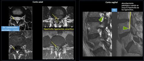 Resonancia Magnética En La Región Lumbar Ajpii