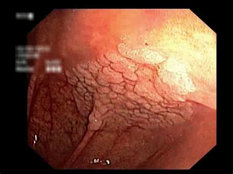 Polyp Classification Object Detection Dataset By Polyp Classification