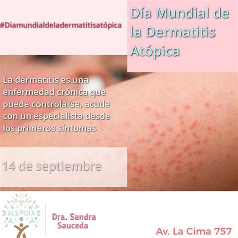 Dra Sandra Sauceda Pedialergias El 14 De Septiembre Día Mundial De