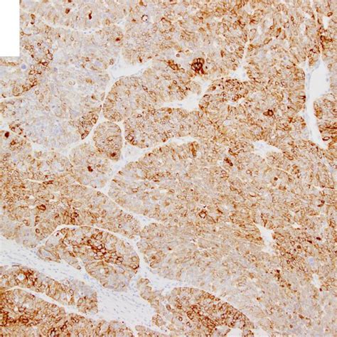 A Epithelial Cell Proliferation With Partial Glandular Duct Formation
