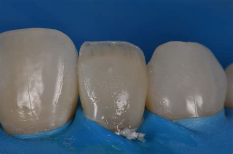 Generating Translucency And Window Effects In A Composite Veneer