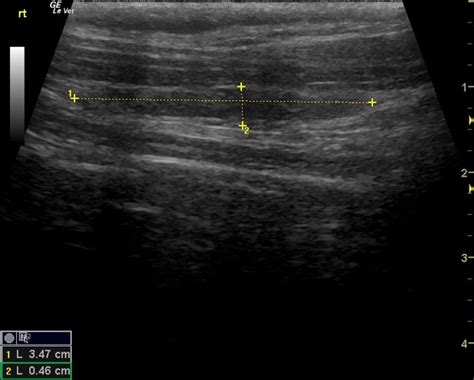 Neuroendocrine Tumor Of The Left Thyroid In A 6 Year Old MN Shepherd