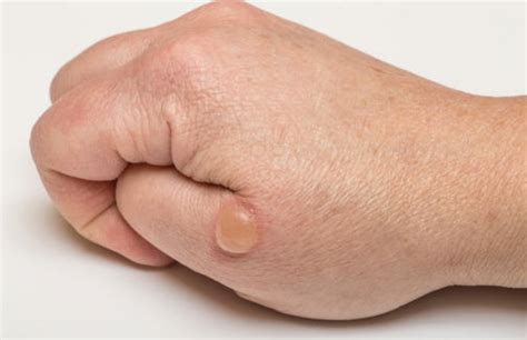Complete Care Dermatology Dermatologist Lake Success Ny Diabetes