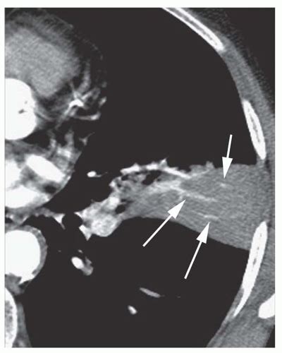 Consolidation And Atelectasis Radiology Key