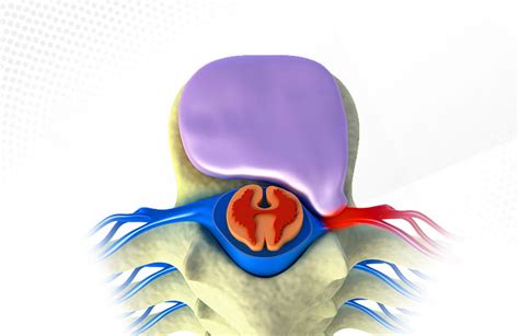 Pinched Nerve How Long Will It Persist Aspc Manipulation Therapy