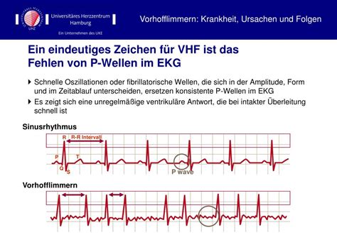 Ppt Vorhofflimmern Krankheit Ursachen Und Folgen Powerpoint