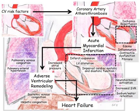 Myocardial Infarction Prevention