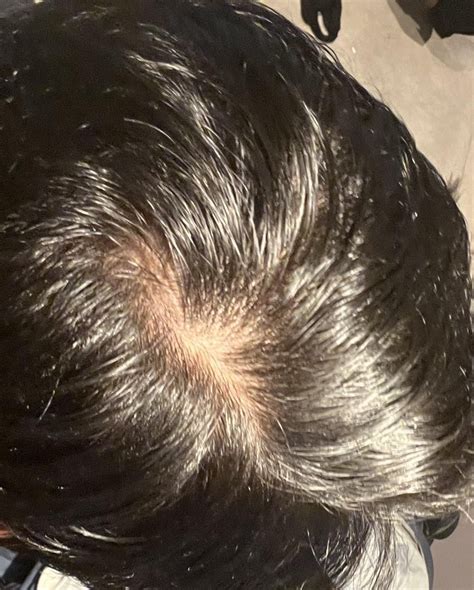 Hairstyle Suggestions For Diffuse Thinner R Tressless