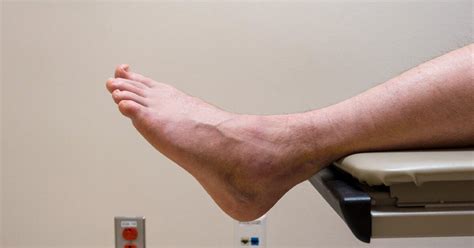 Fracture Of The 5th Metatarsal Types Symptoms And Treatment