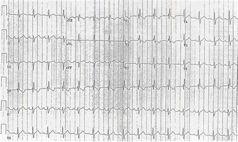 Topic Atrial Septal Defect Ostium Primum 12 Lead Ecg