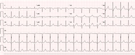 Palpitations Tags Differential Diagnosis Of