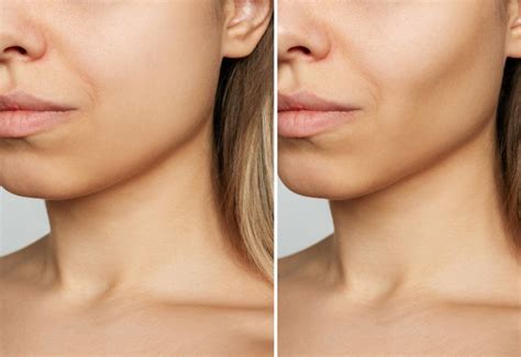 What Causes Sunken Cheeks And Can They Be Treated Diaminyaesthetics
