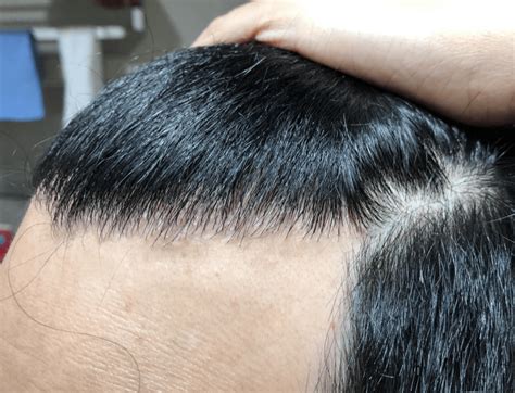 Is This Cobblestoning R Hairtransplants