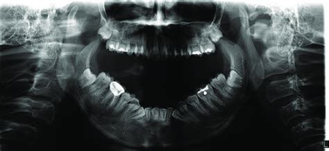 Preoperative Orthopantomograph Showing Bilateral Dislocation Of The Condyle Download