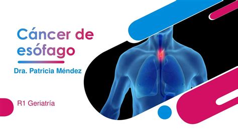Cáncer De Esófago Patricia Mendez Udocz