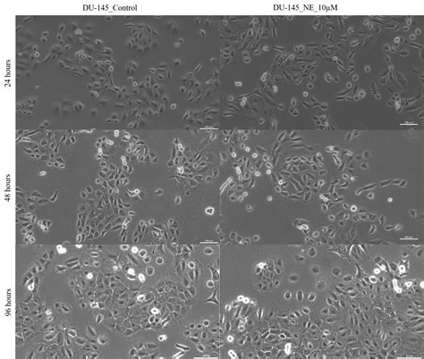 Sympathetic Signaling Facilitates Progression Of Neuroendocrine Prostate Cancer Abstract