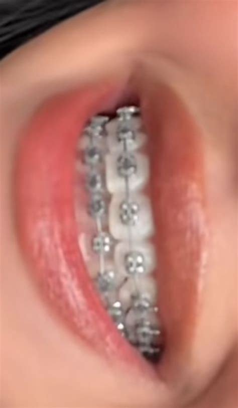 Gray Braces A Stunning Smile Transformation In 2025 Teeth Braces Braces Colors Braces Teeth