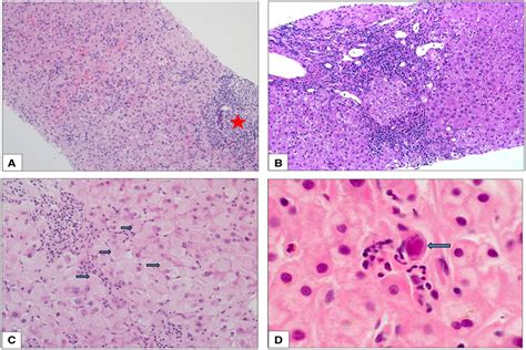 histological patterns of hepatitis and cholangitis clinical liver disease