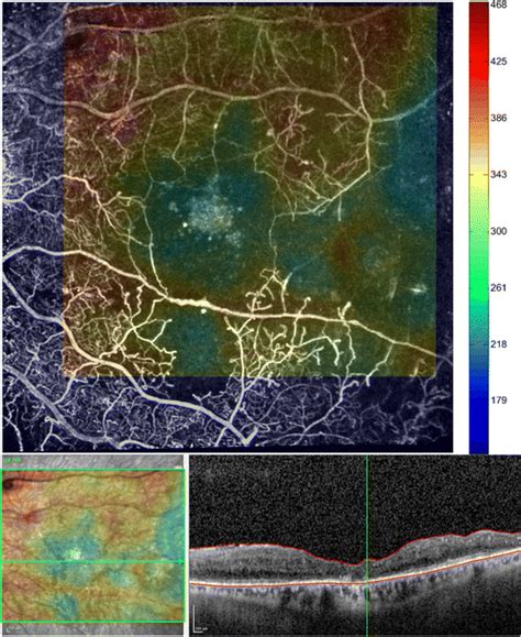 Multimodal Imaging Approach Including The Angiography Component Rfi