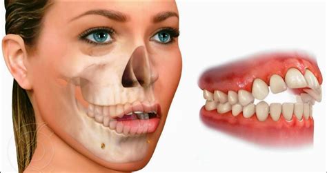 Problemas De Alineación O Maloclusión De Los Dientes