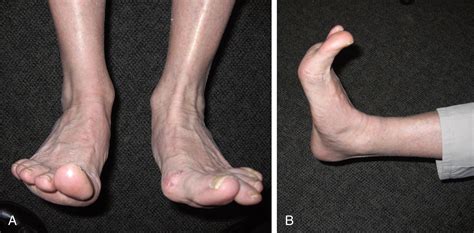 Disorders Of Tendons Clinical Tree