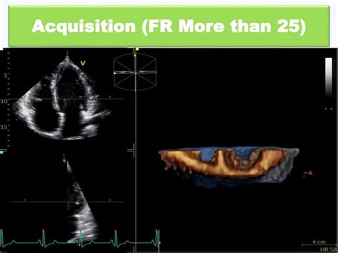 Lv Systolic Function Pptx 3 D Graphics Computer Software And Applications