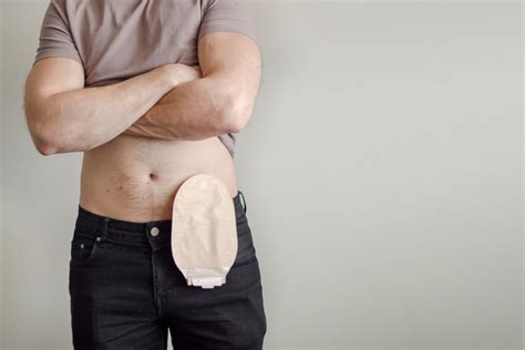 Is An Ostomy For Life Comfizz