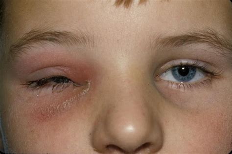 Eye Infection Top Symptoms And Effective Treatment Options