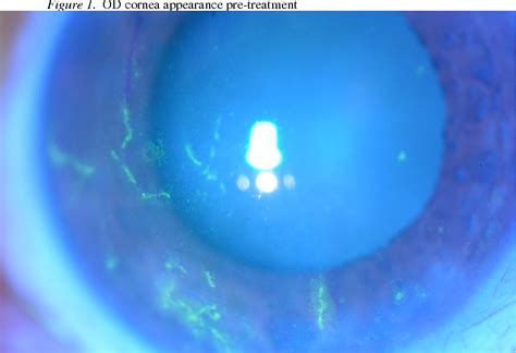 Figure 1 From Late Dendriform Keratitis In Herpes Zoster Ophthalmicus Evidence For Late