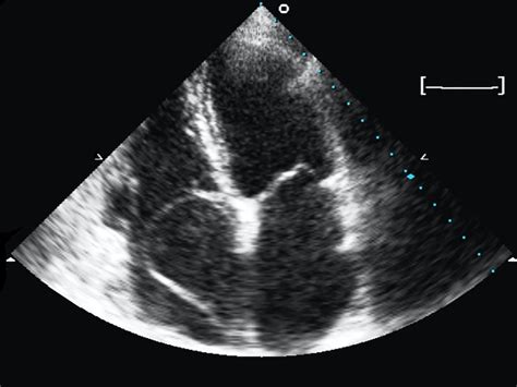 Aneurisma Del Septo Interauricular ¿cómo Evitar El Sobrediagnóstico