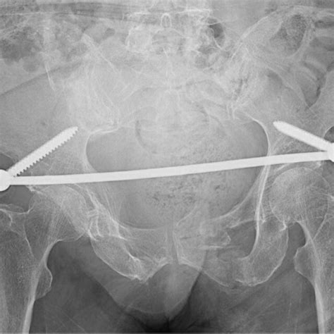 Fragility Fractures Of The Pelvis Current Practices And Future