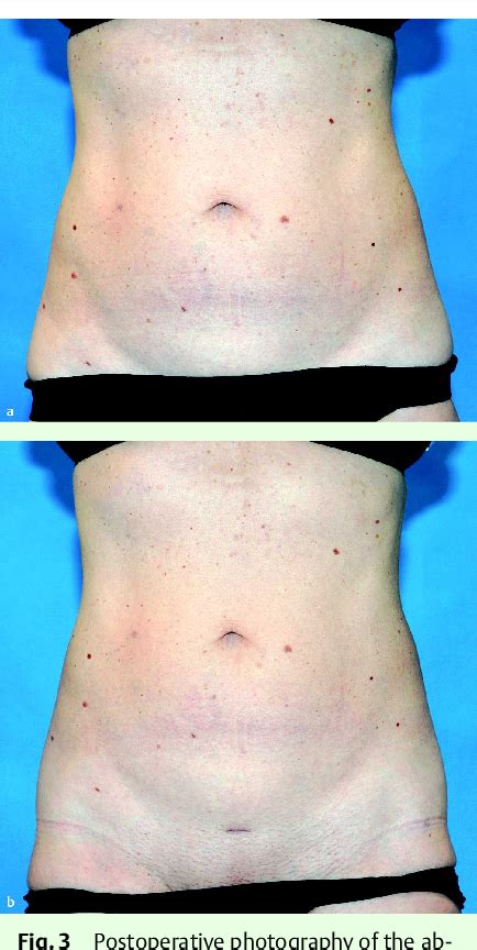 Laparoscopic Cholecystectomy Incisions